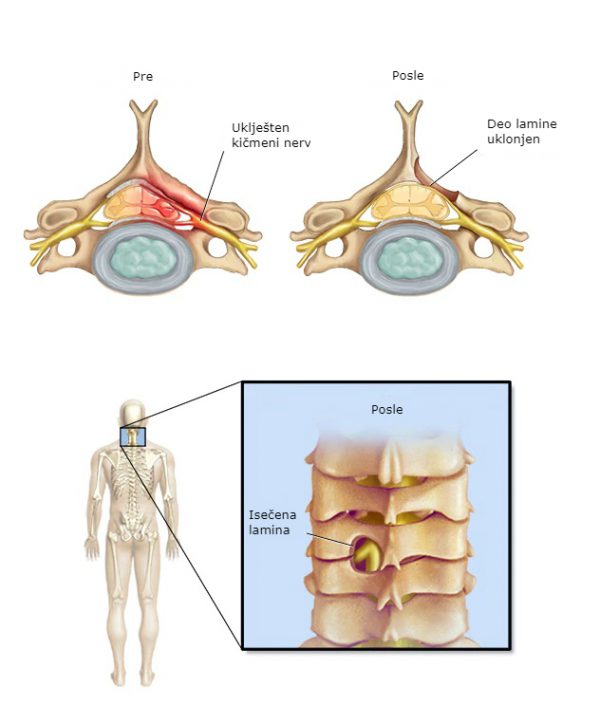 SPINALNA STENOZA – simptomi, uzroci, dijagnoza, lečenje - SPINEMAX